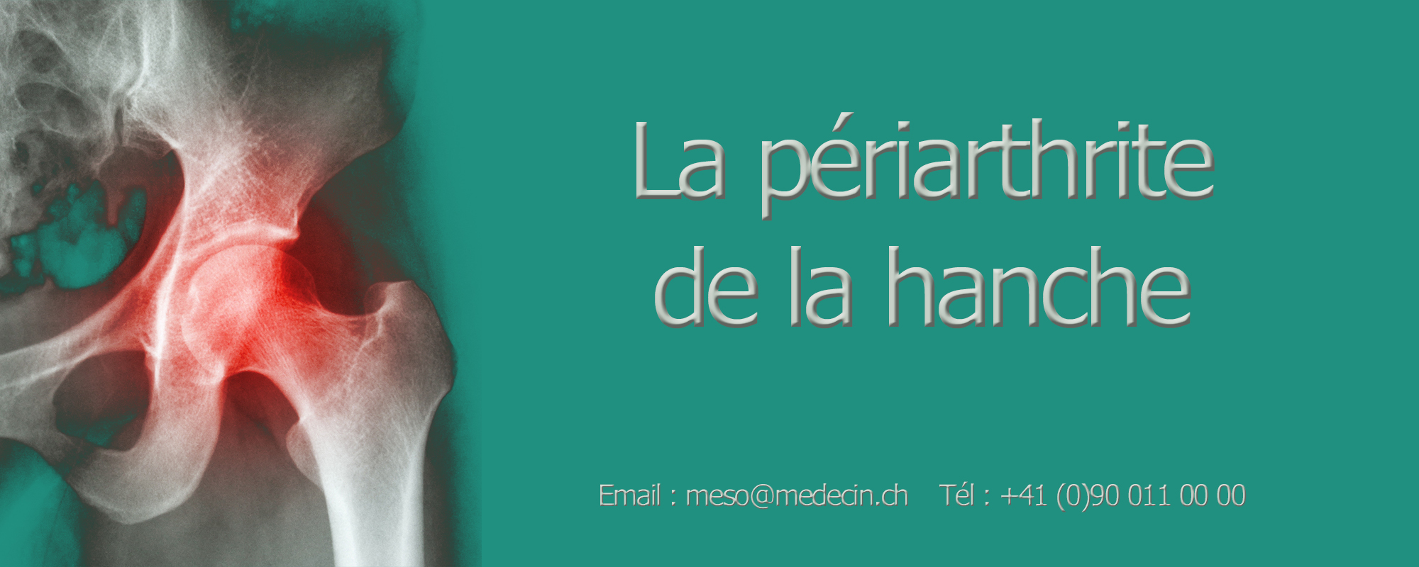 Périarthrite de la hanche - seocres15chibert